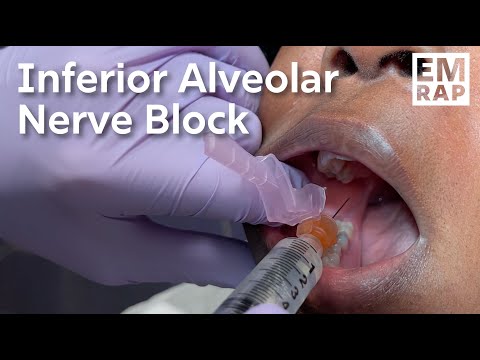 Which Nerve Block For Tooth Extraction