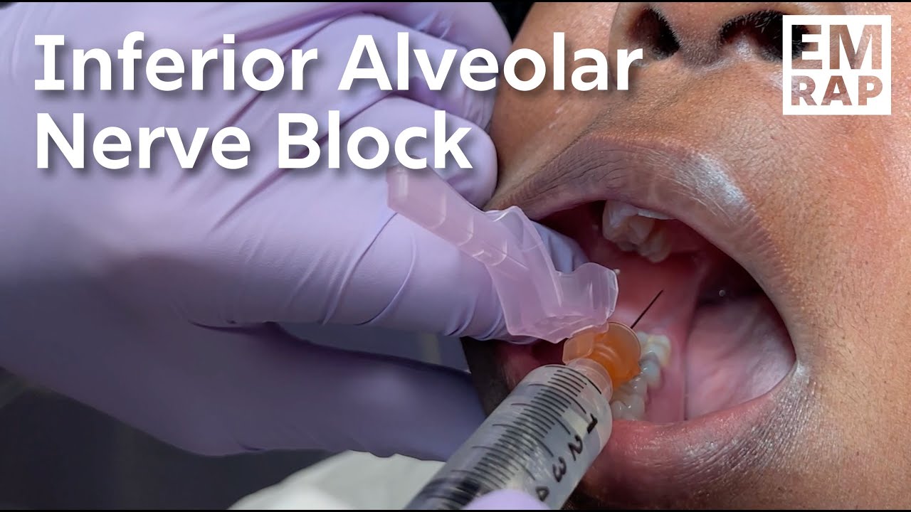Inferior Alveolar Nerve Block - YouTube