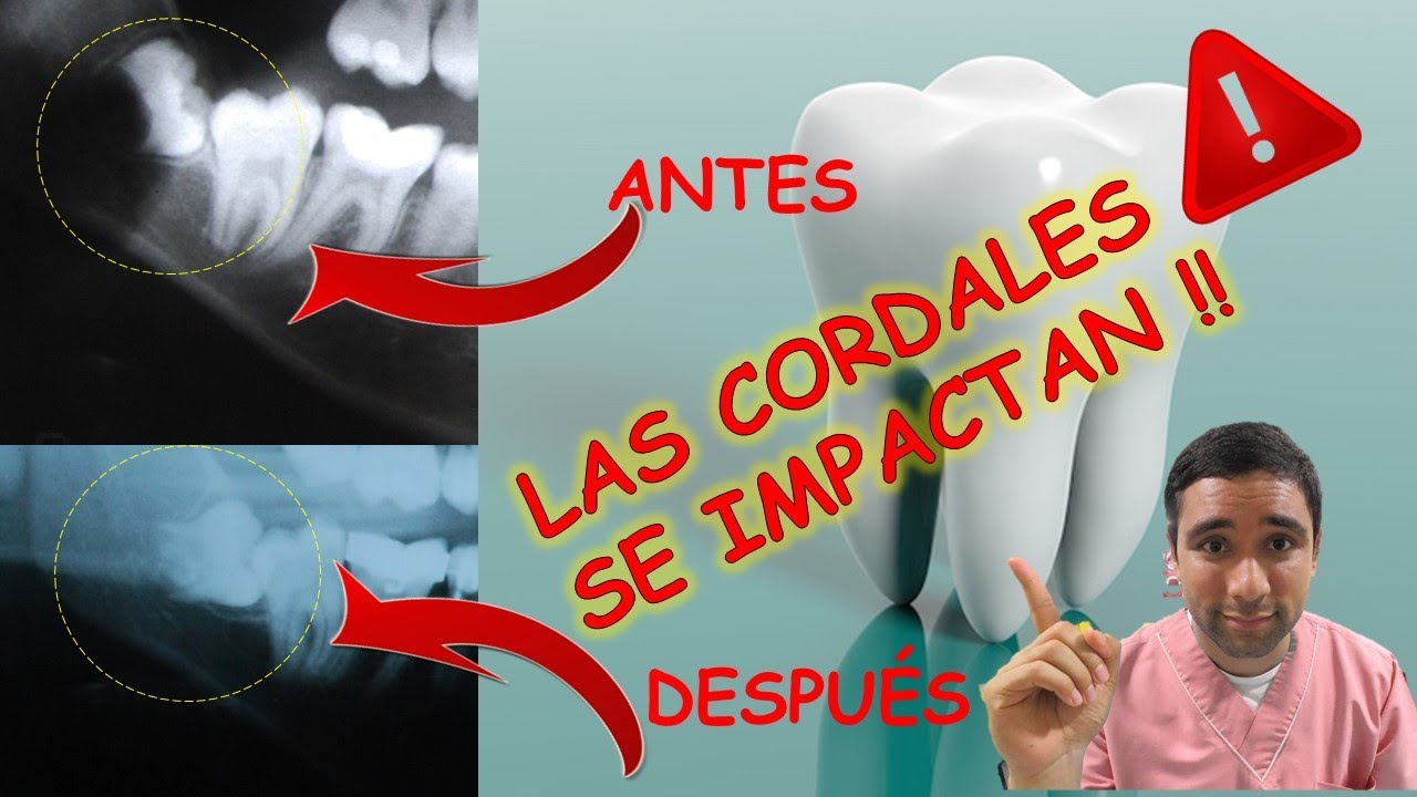 CORDALES Y ORTODONCIA! ¿SE DEBEN SACAR EN LOS NIÑOS Y ADOLESCENTES? No ...
