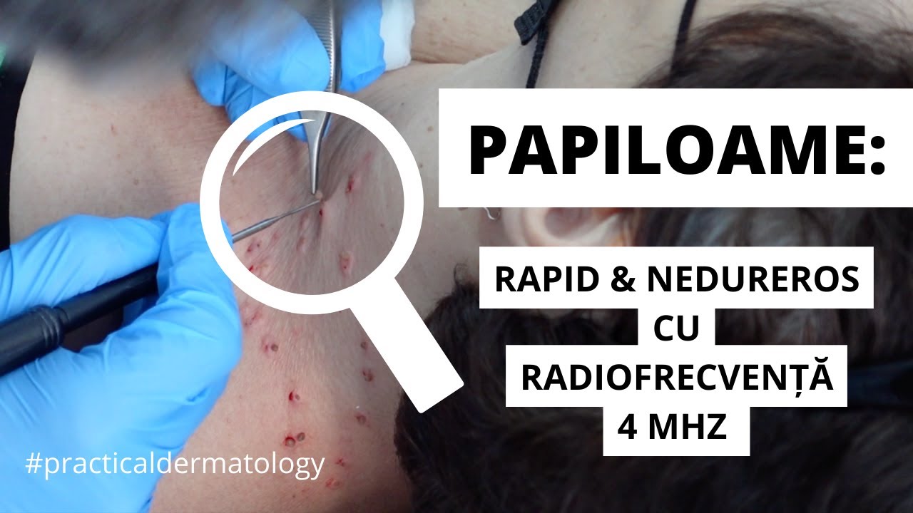 Indepartare PAPILOAME: rapid si NEDUREROS cu RADIOFRECVENTA de 4 Mhz ...