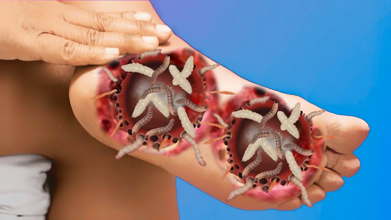 ASMR removal trypophobia Maggots & Worm infected Foot 🦶| ASMR Animation ...