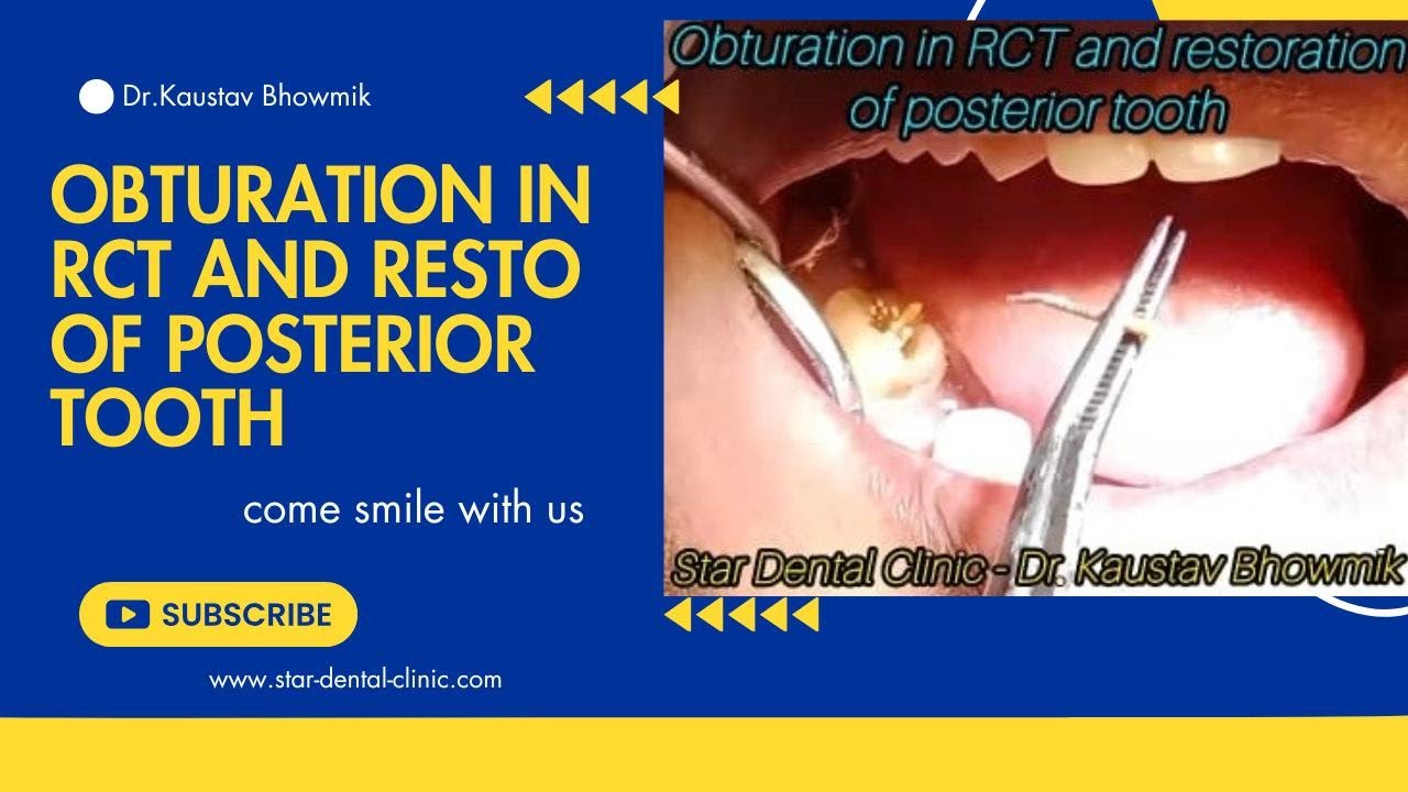 Obturation in rct and resto of posterior tooth - YouTube
