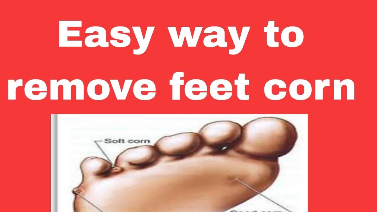 Easy process to remove feet corn - YouTube