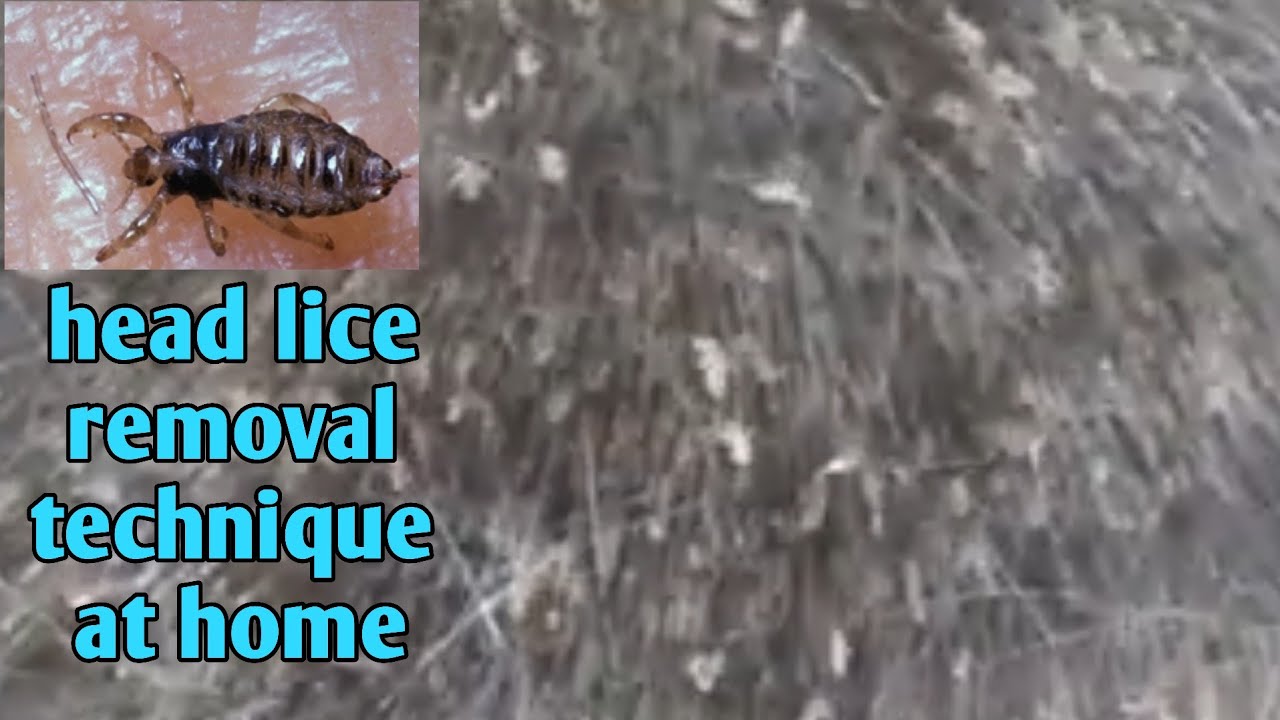 lice treatment in safe and natural way at home #licetreatment # ...