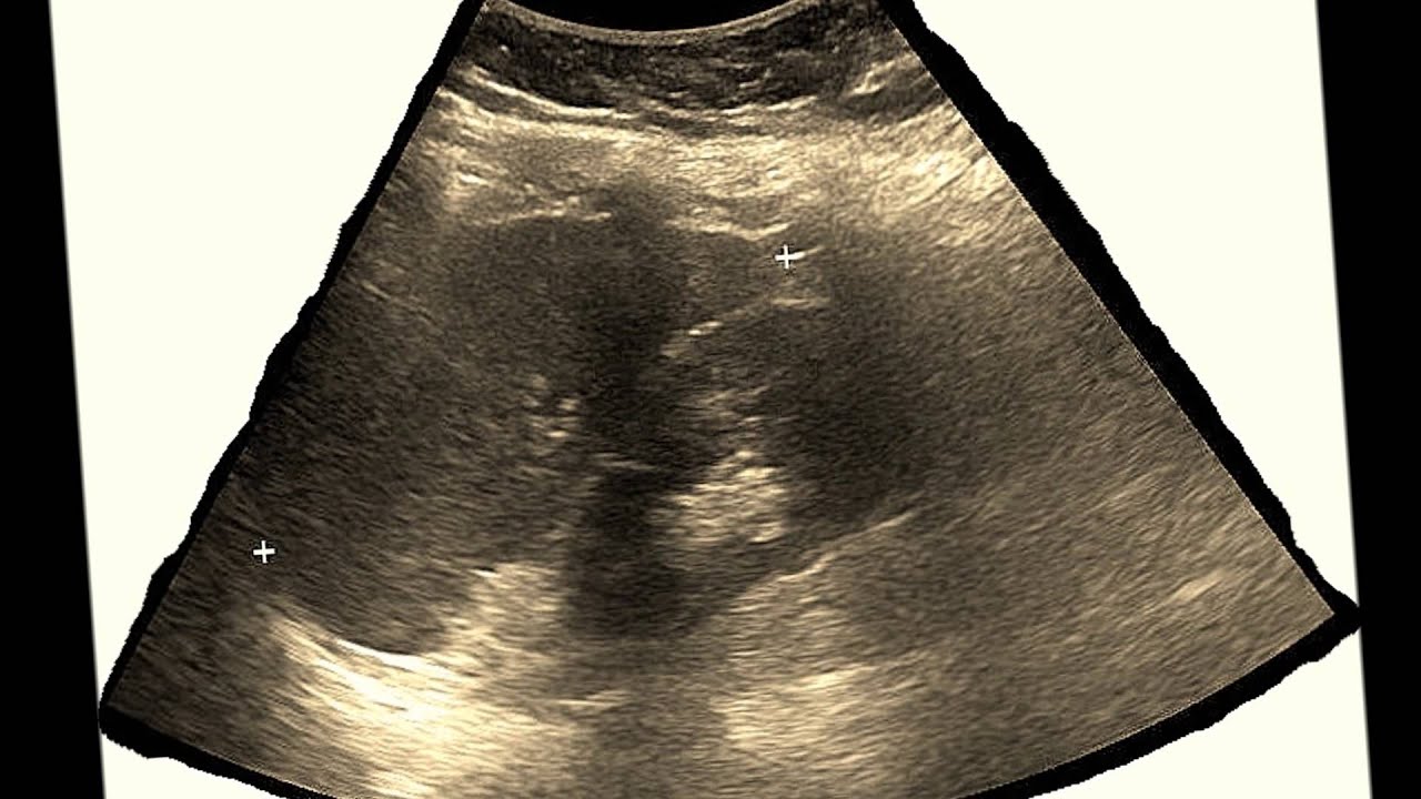 My Parasitic Twin Brother! - YouTube