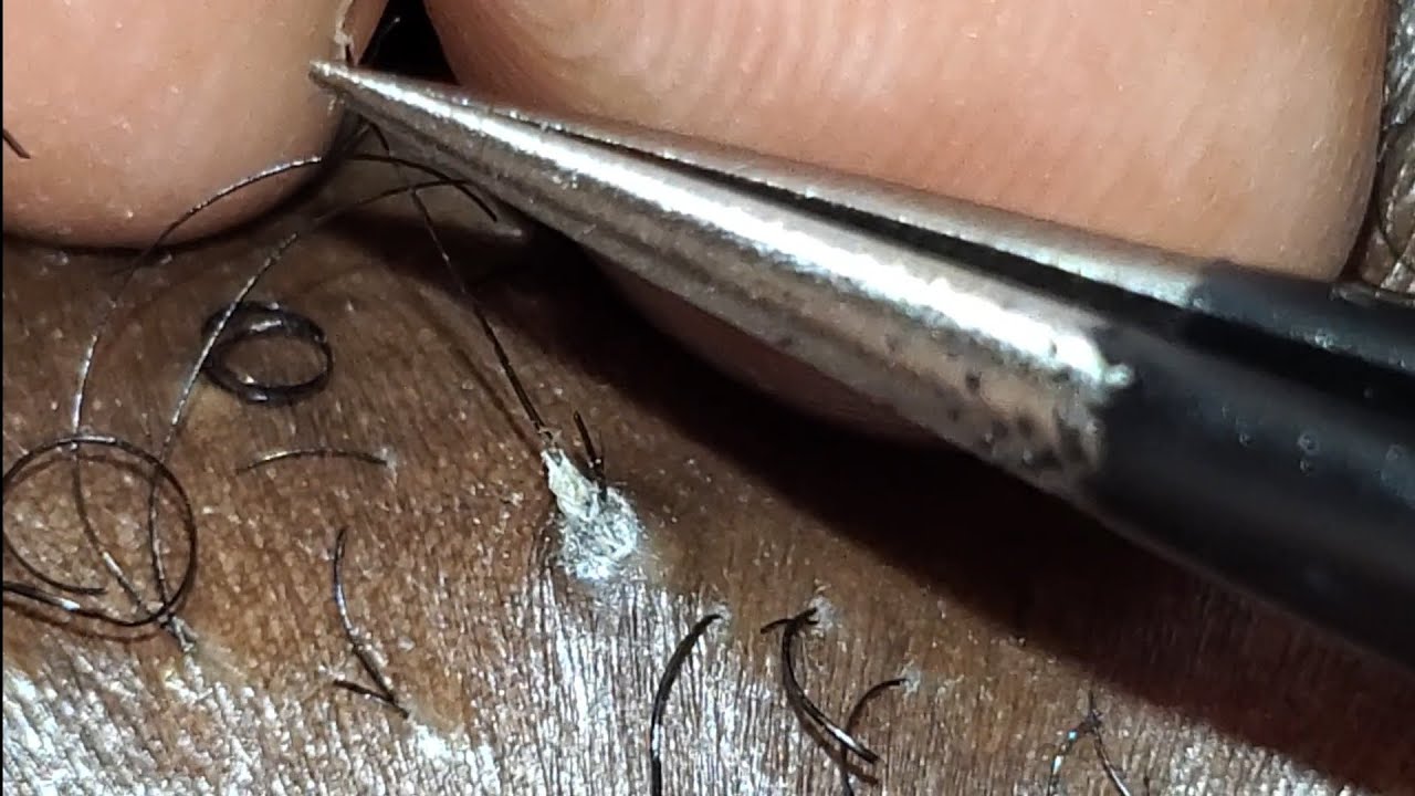 Juiciest ingrown hair removal - YouTube