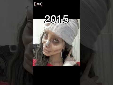 INILAH KASUS OPERASI PLASTIK YANG GAGAL 😱 #shortsfeed #shorts #shortsyoutube