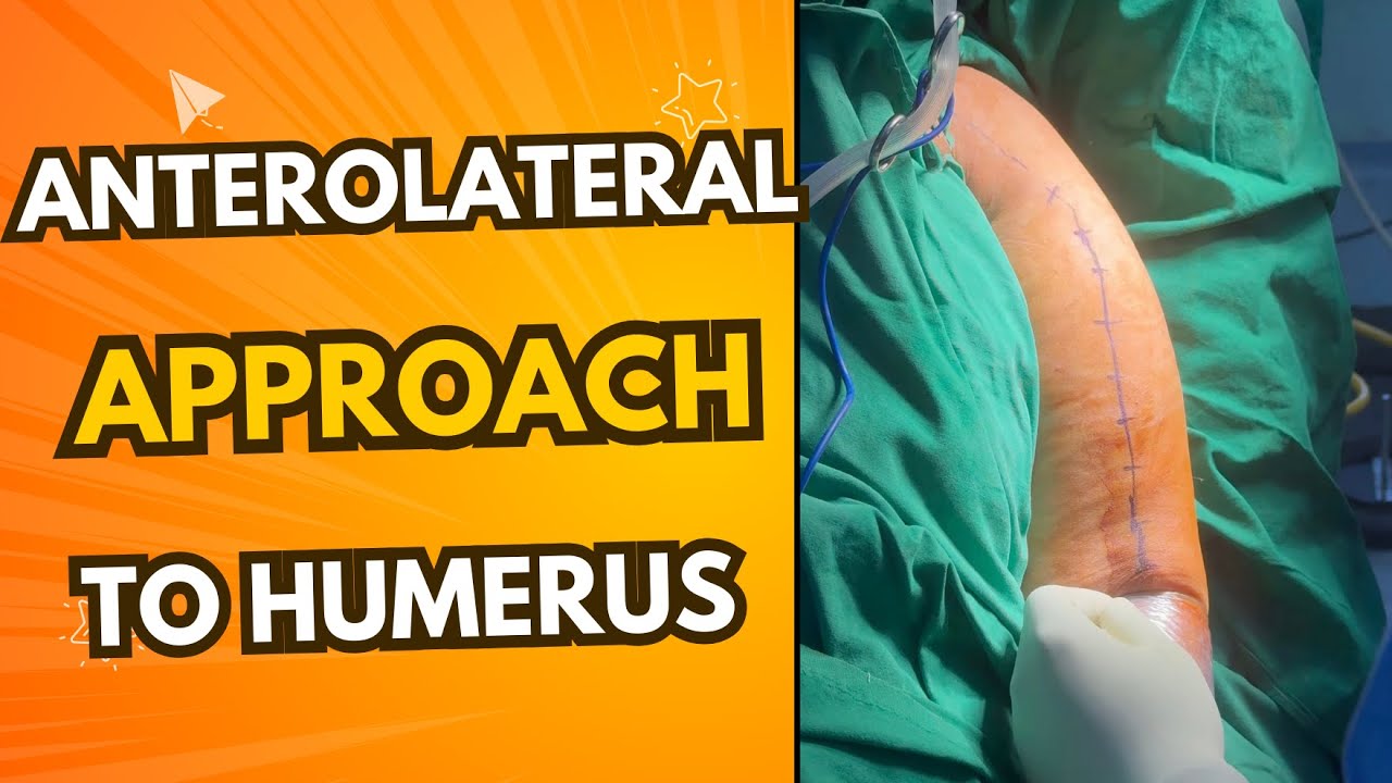 Anterolateral vs Posterior Approach to Humerus Shaft | Best Surgical ...