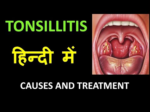 Tonsillitis, Causes, Signs and Symptoms,Diagnosis and Treatment ...