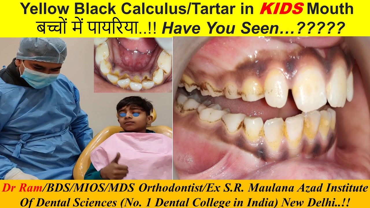 Yellow Black Calculus/Tartar in KIDS Mouth I बच्चों में पायरिया ...