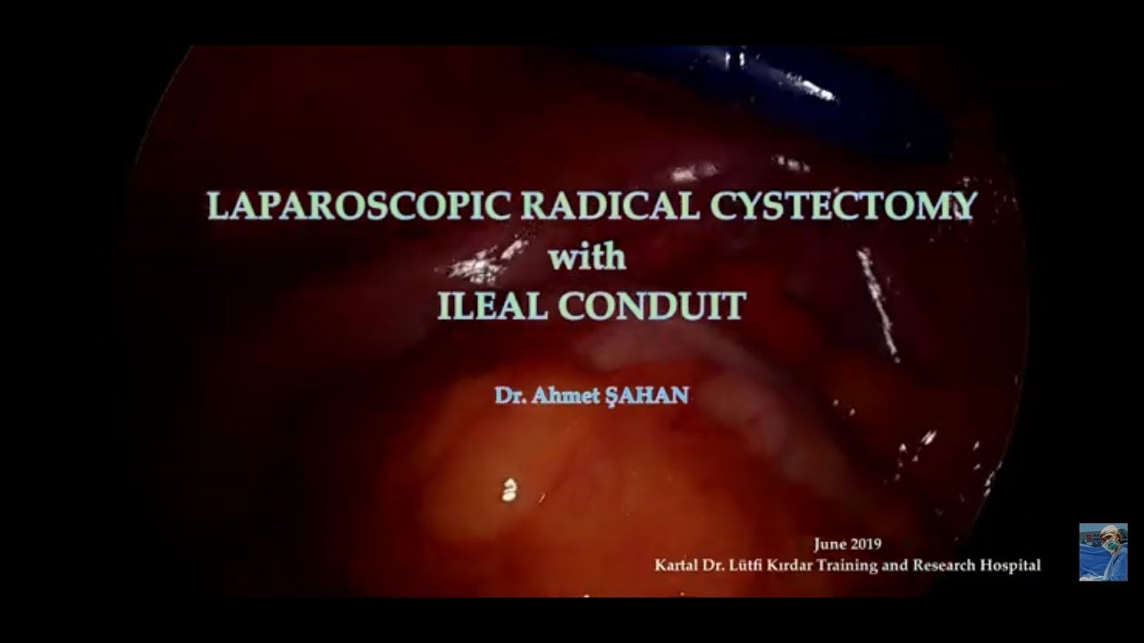 Laparoscopic Radical Cystectomy - YouTube