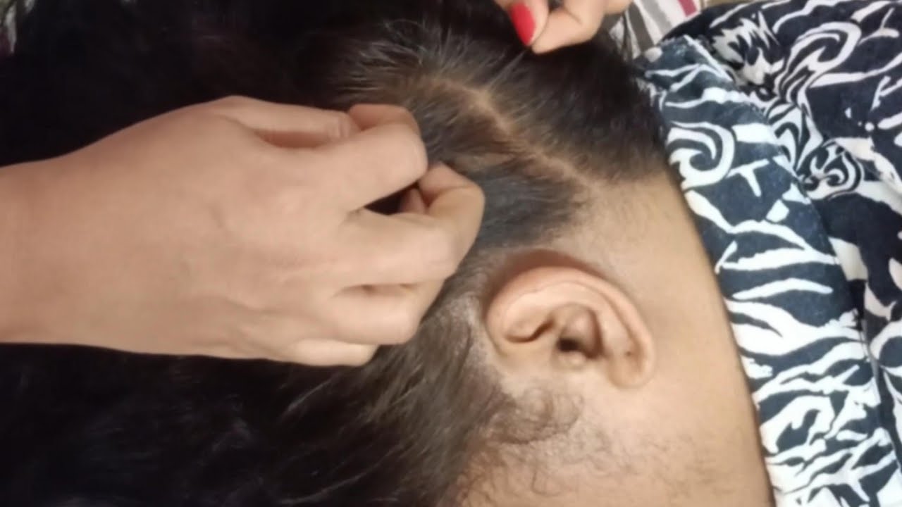 The Satisfying Science of Scalp Inspections - YouTube