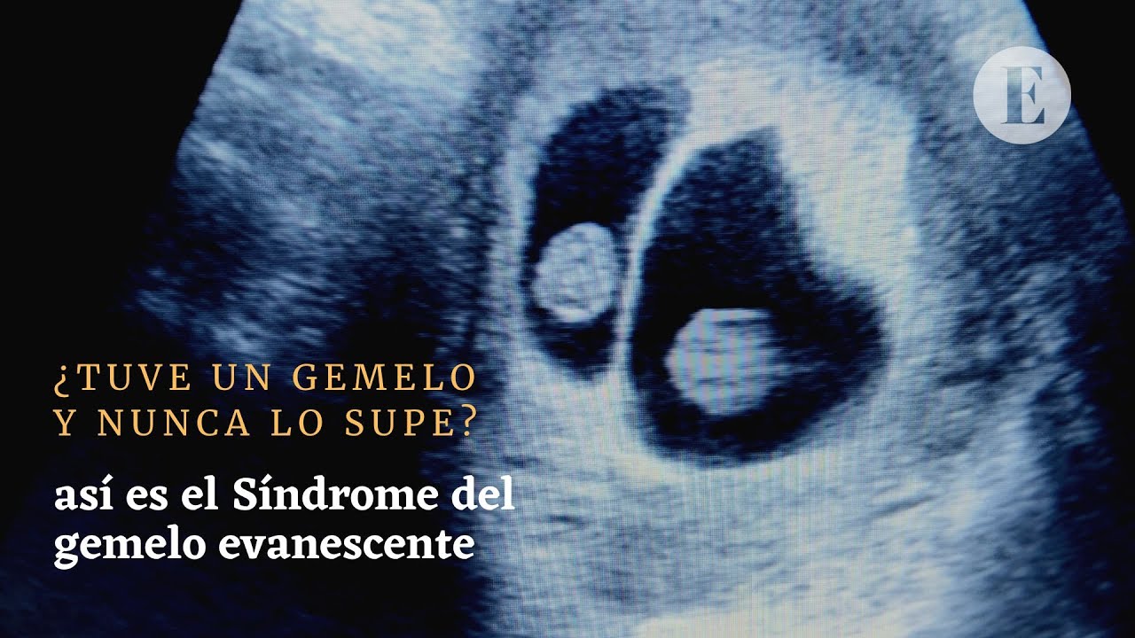 ¿Tuve un gemelo y nunca lo supe? así es el Síndrome del gemelo ...