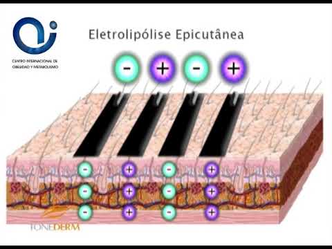 electrolipólisis epicutánea - YouTube