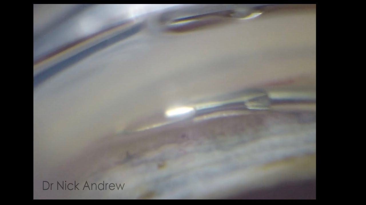 How to implant the Hydrus glaucoma stent and prevent it from diving ...