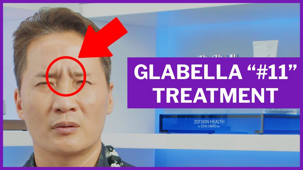 TREATING GLABELLA (#11) | Dr. David Yew - YouTube