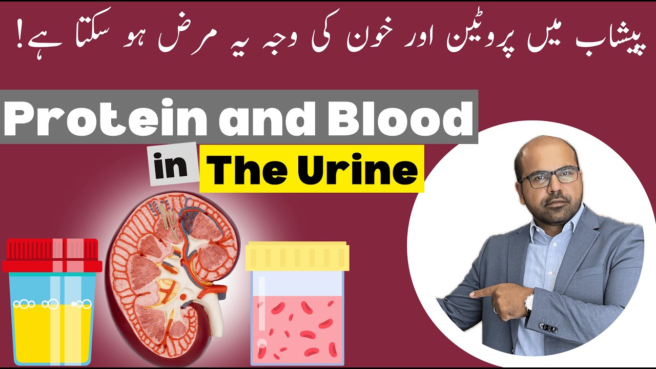 Have Blood And Protein In The Urine Lupus Nephritis Episode 113 have-blood-and-protein-in-the-urine-lupus-nephritis-episode-113