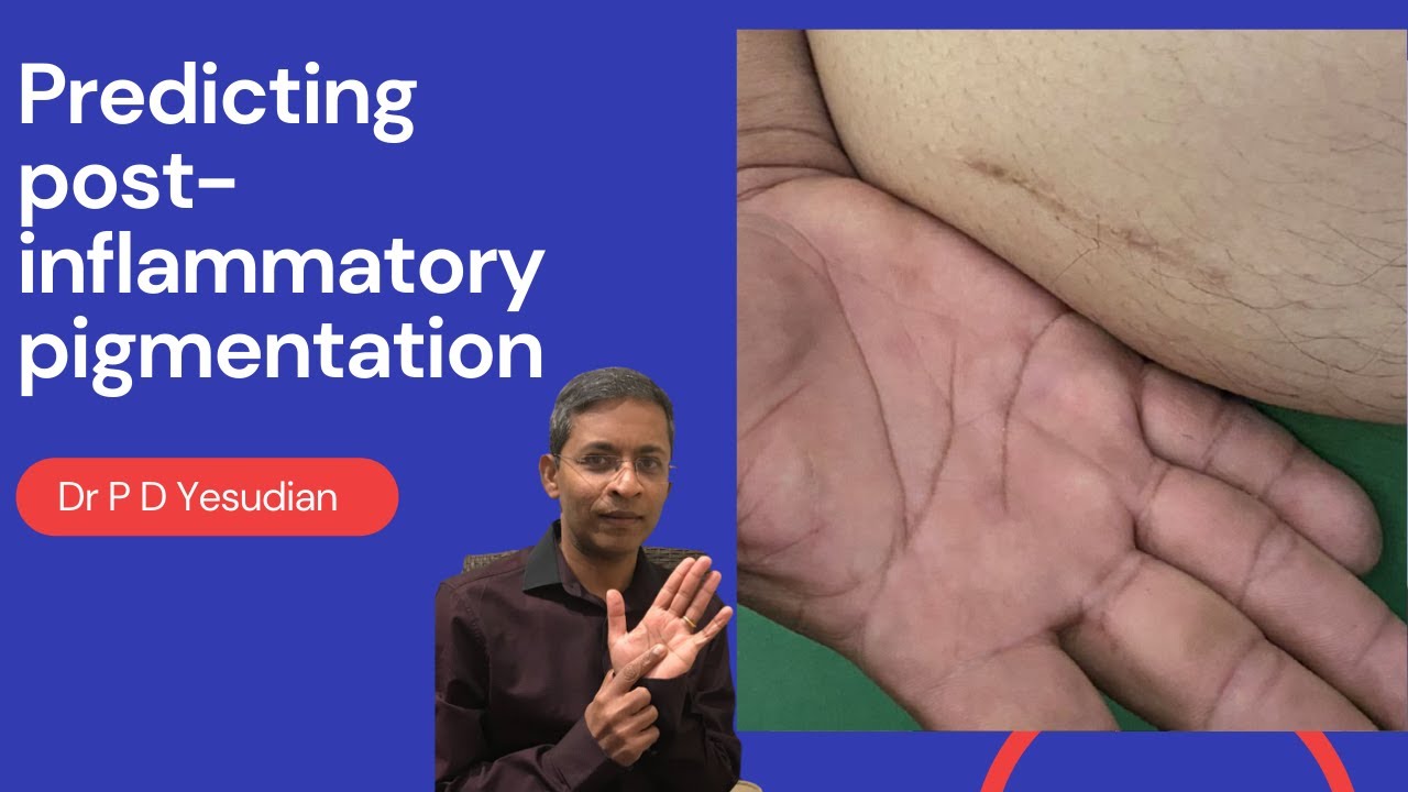 Palmar crease pigmentation - a predictor of post-inflammatory ...