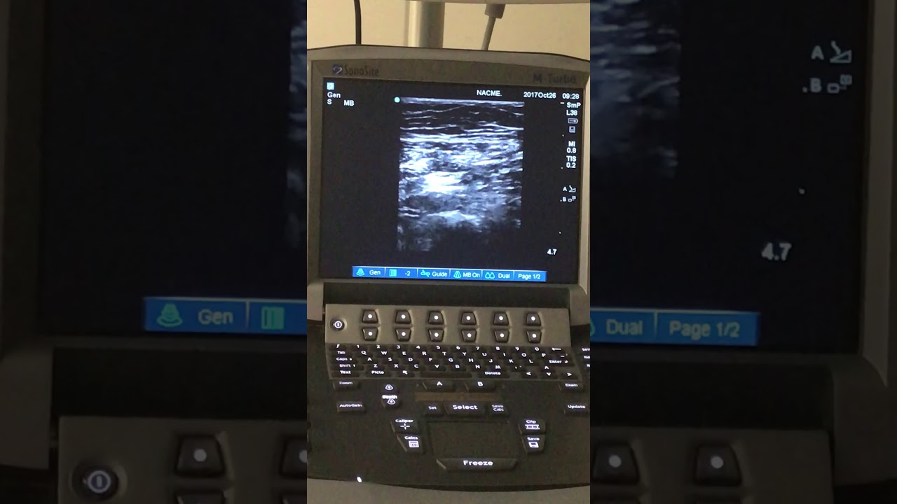 PECS Block - YouTube