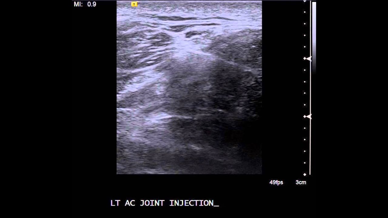 AC joint injection 1 - YouTube