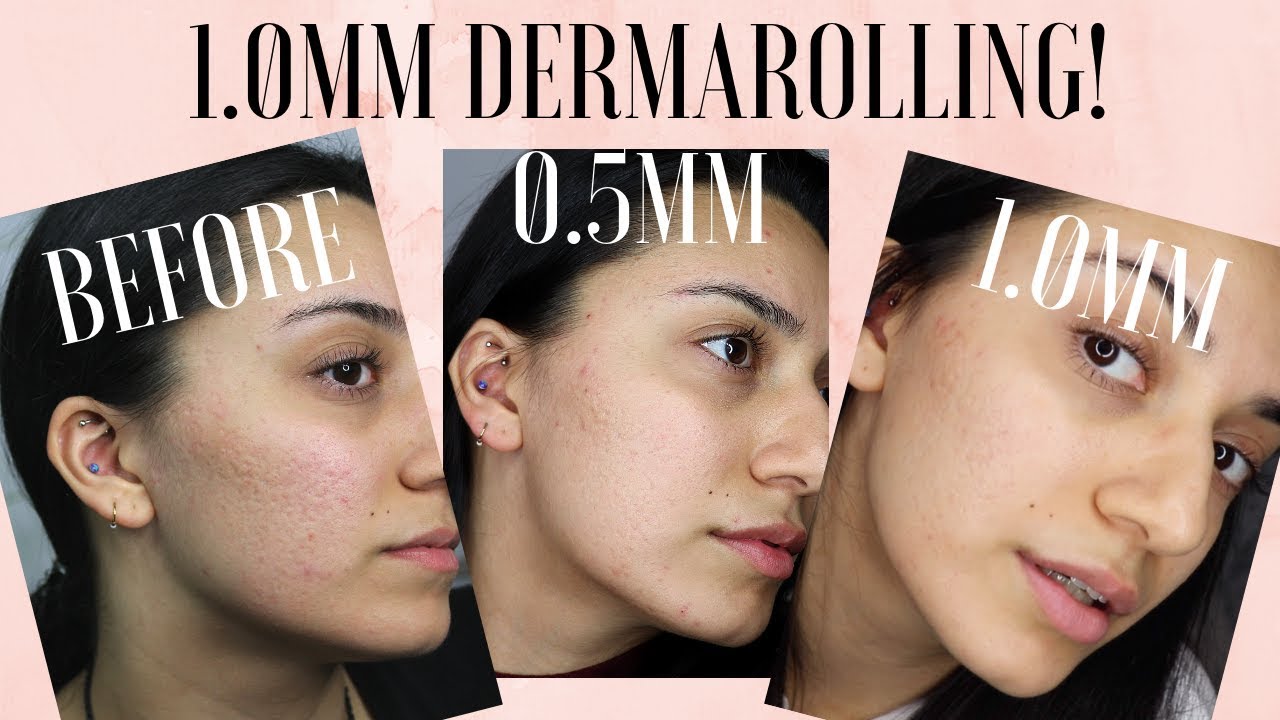 0 5mm Vs 1mm Dermaroller Any Difference YouTube