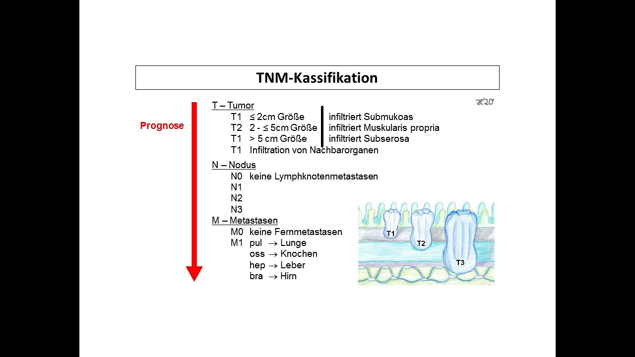 TNM-Klassifikation (Stadieneinteilung) | Strahlentherapie Prof. Hilke ...