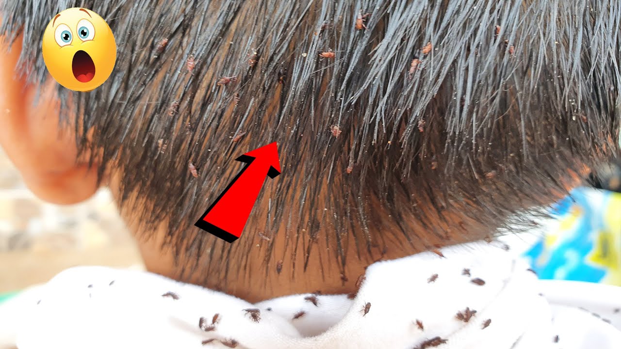 Lice extraction - Remove million Giant lice from boy's hair - YouTube