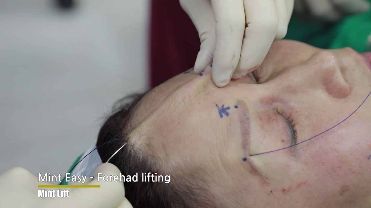 Mint Lift, Mint lift 43 Easy, Forehead, absorbable thread - YouTube