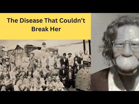 Rare Disease Turned Her Face Unrecognizable | Grace McDaniels Documentary