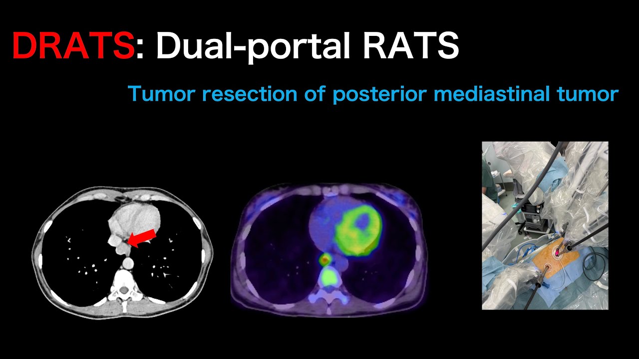 142】DRATS: dual-porta RATS posterior mediastinal tumor resection - YouTube