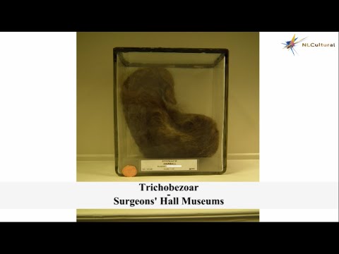 Trichobezoar at The Surgeons' Hall Museums - YouTube