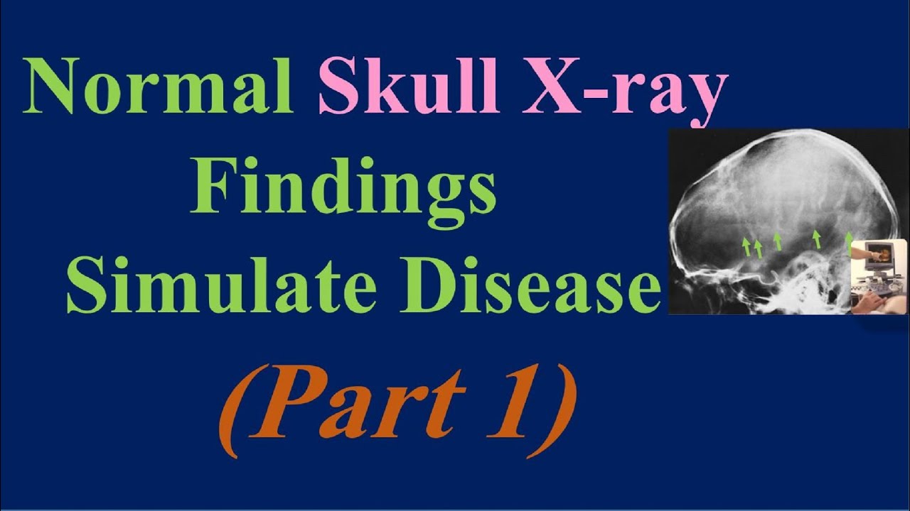 Normal Skull X ray Findings Simulate Disease Part1 - YouTube