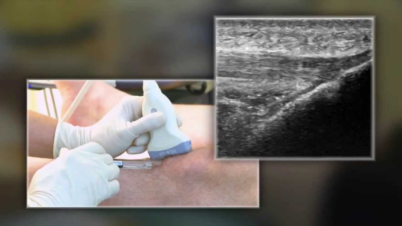 OSTENIL® Tendon injection 2/4: Knee Tendon - YouTube