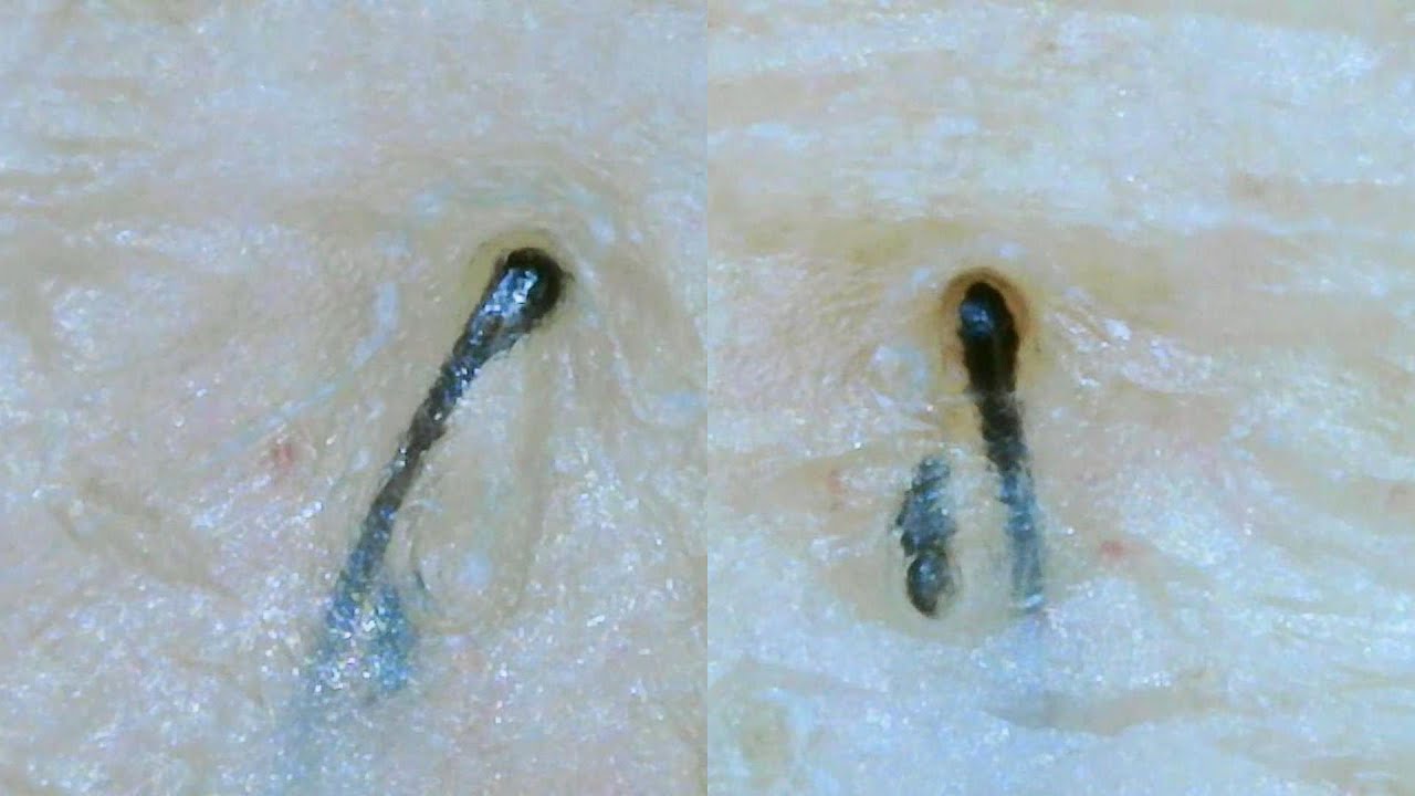 Plucking hairs ZOOM #100 - YouTube