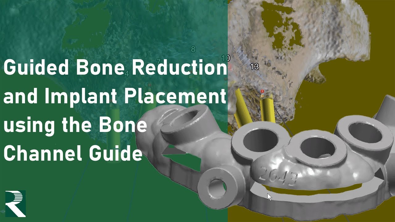 Guided Bone Reduction and Implant Placement Using the Bone Channel ...
