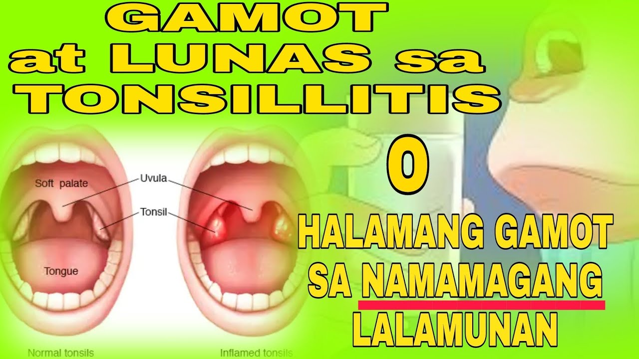 Halamang Gamot sa namamagang Lalamunan | Tonsillitis | - YouTube