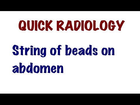 QUICK RADIOLOGY: String of beads appearance on abdominal radiograph ...