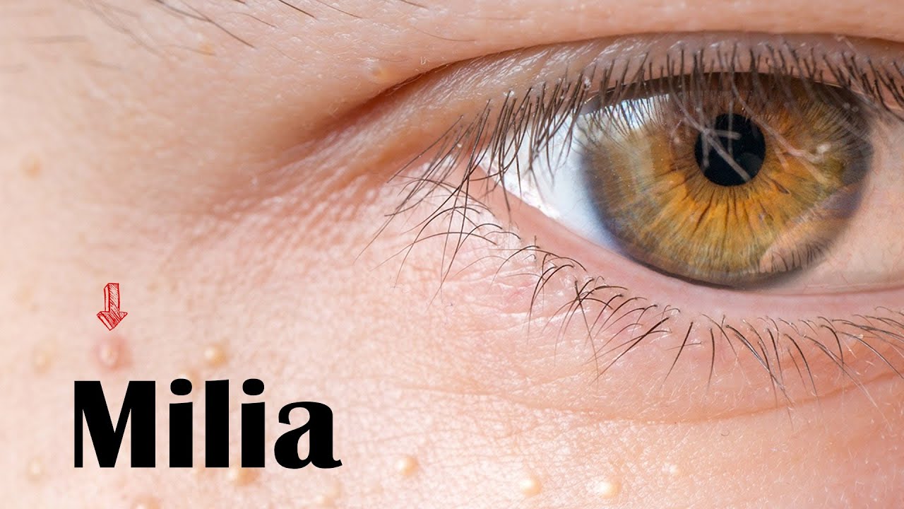 Milia - Types, Causes, And Treatment - YouTube