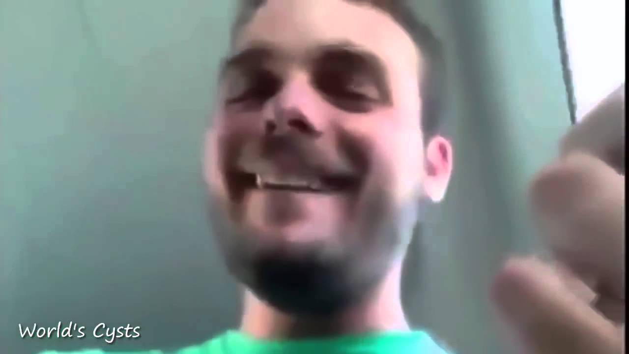 Big Cyst Pimple Popping From ArmPit Blackheads Extractions Close Up ...