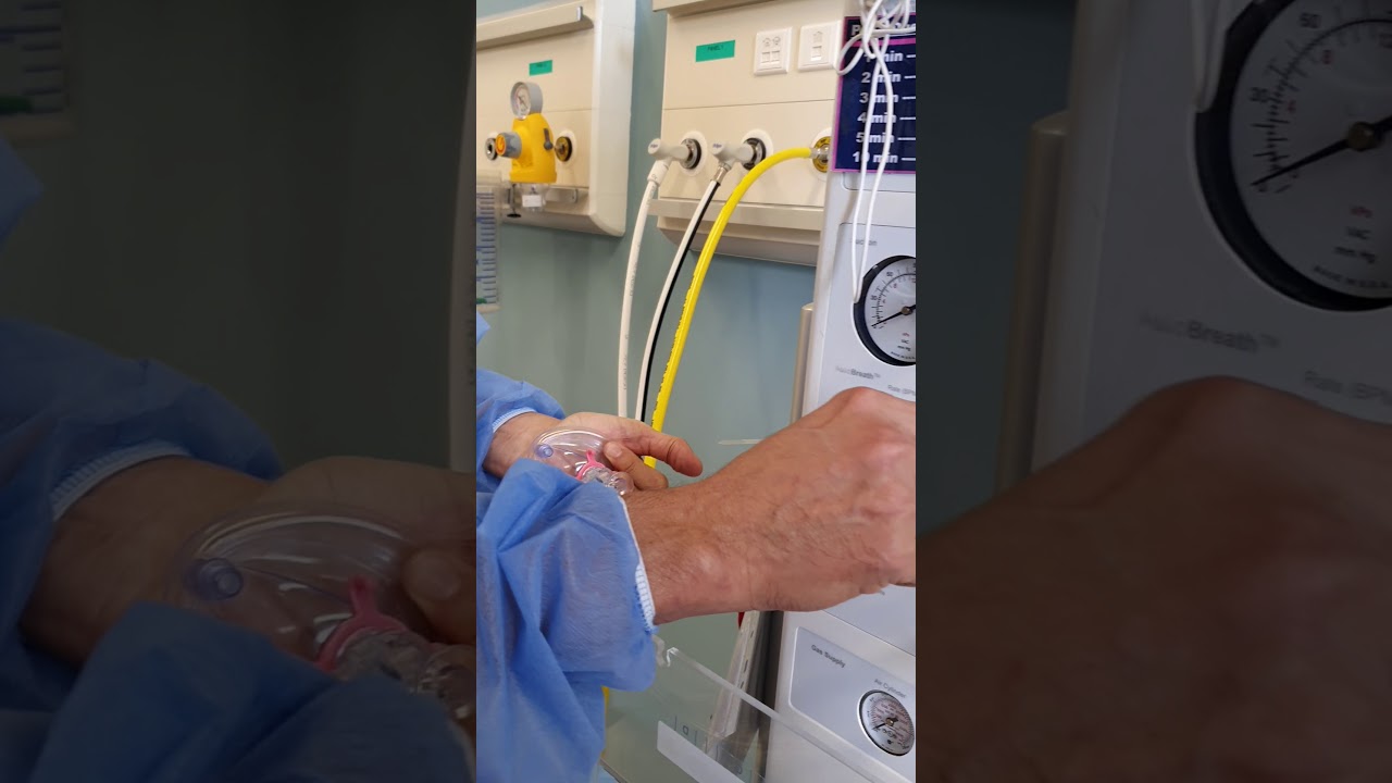 Positive pressure ventilation (PPV) using T-piece resuscitator - YouTube