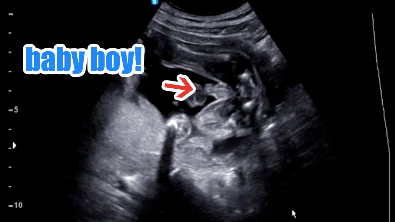 20 Week Baby Boy Ultrasound - YouTube