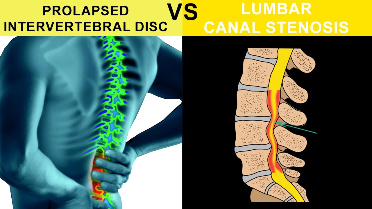 "Prolapsed Intervertebral Disc vs Lumbar Canal Stenosis |Understanding ...