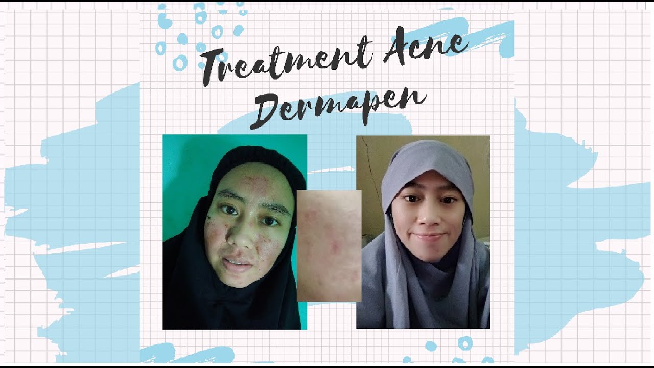 Treatment For SCAR (Bopeng) Dermapen 2021 Di Rumah Saja - YouTube