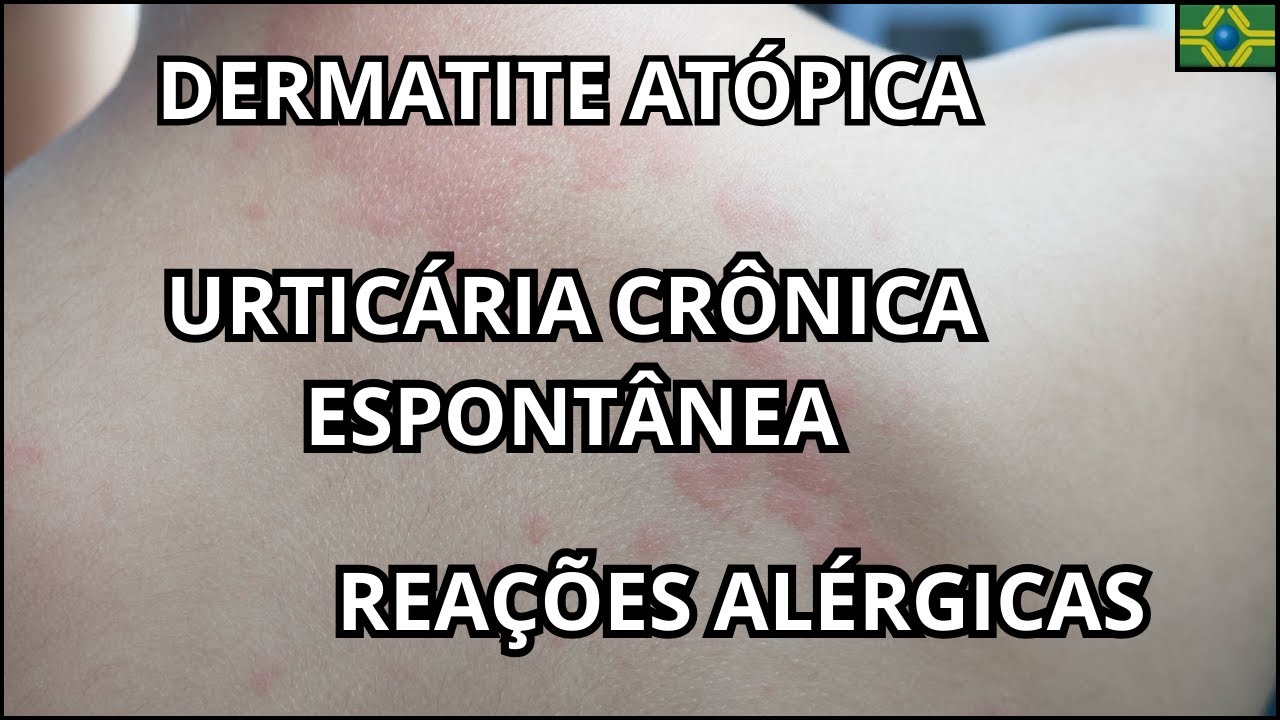 URTICÁRIA CRÔNICA ESPONTÂNEA | DERMATITE ATÓPICA | BIOTERAPIA ...