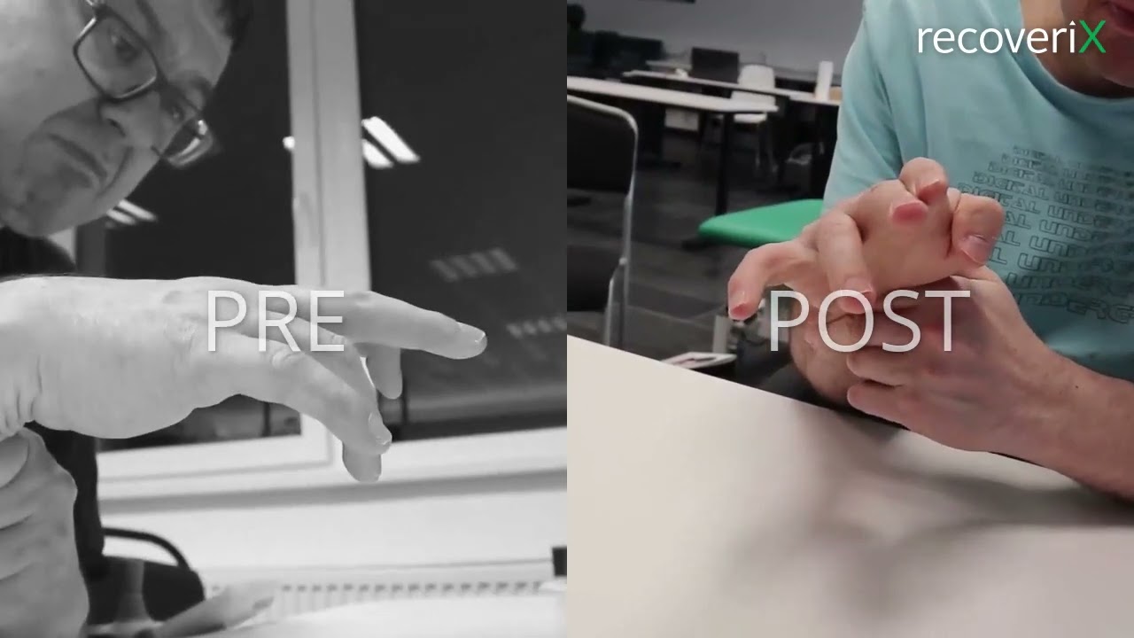 Before/After recoveriX - stroke - FMAUE - ST7