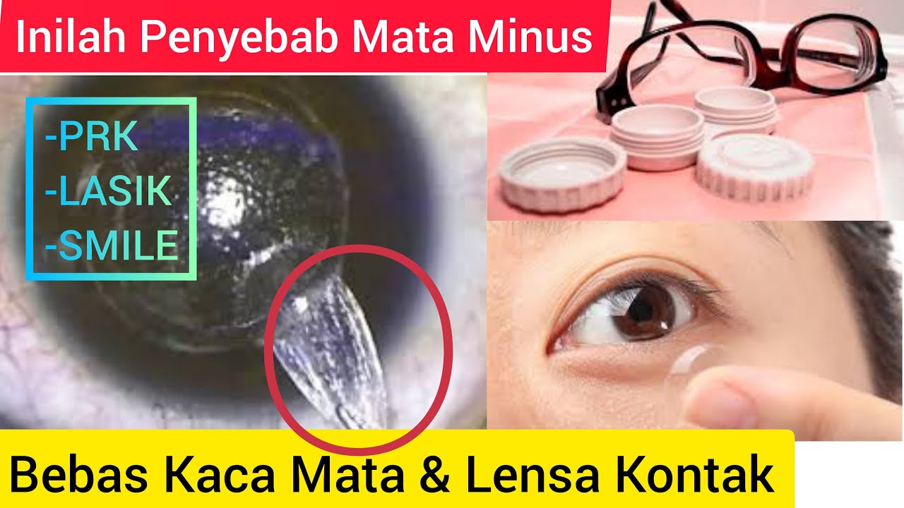 3 Jenis Operasi Untuk Mata Minus || PRK, Lasik, Relex Smile, Laser ...