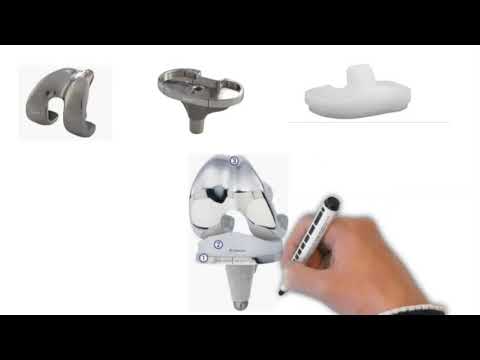 Total Knee Replacement Patient specific instrumentation - YouTube
