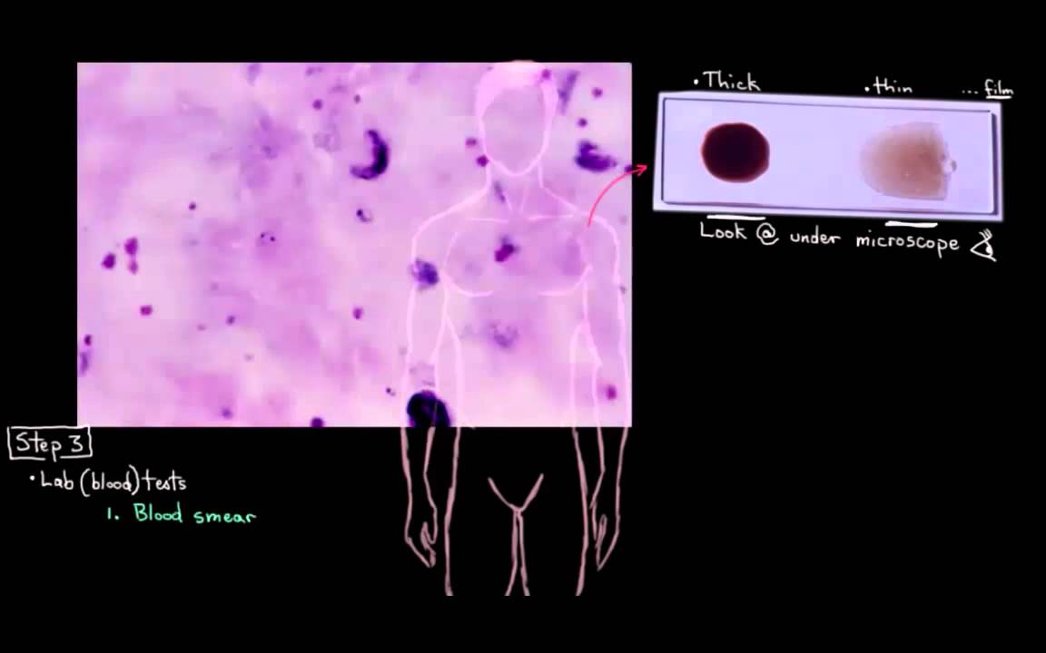 Diagnosing Malaria - YouTube