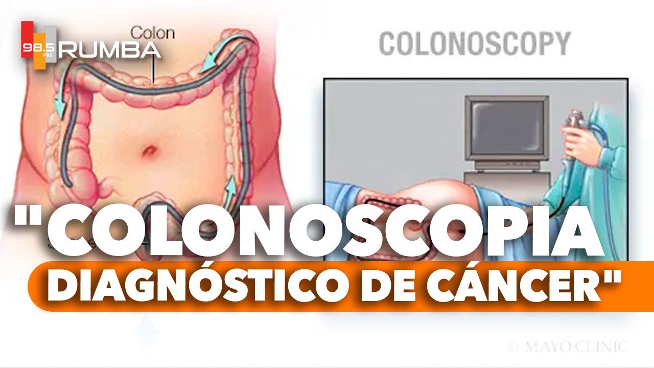 La colonoscopia es el estudio por excelente para diagnosticar cáncer de ...