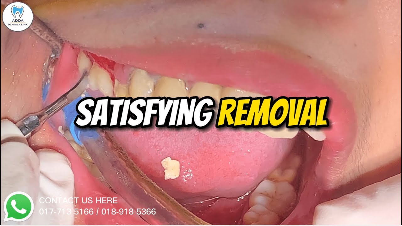 SATISFYING REMOVAL | SCALING | Cuci Gigi | Dentist | Adda Dental Clinic ...